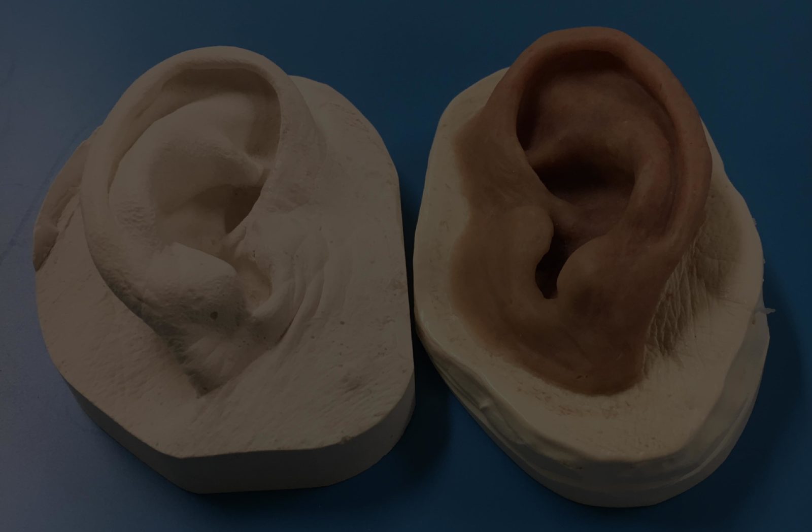 Keloid Management - CM Prosthetics